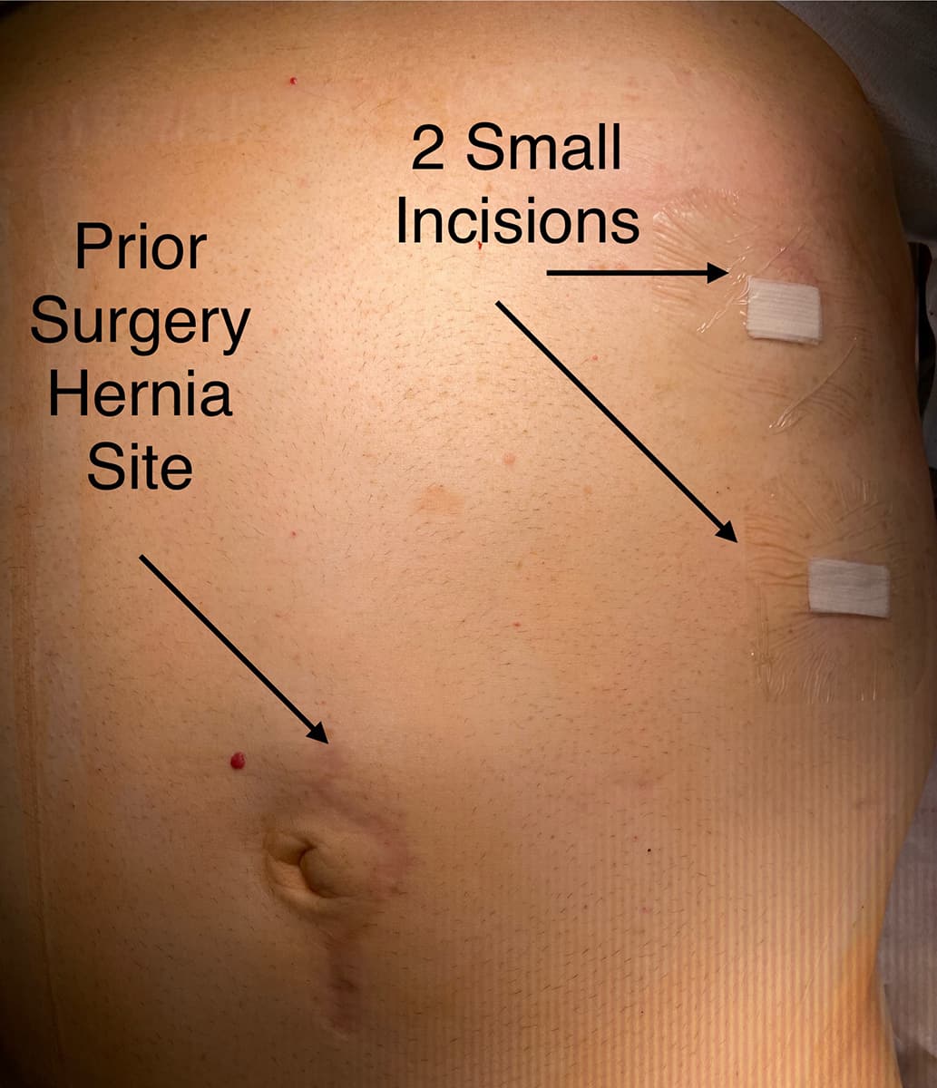 Hernia Watch This Insightful Video On Inguinal Hernia Wherein Dr Hernia Watch This Insightful Video On Inguinal Hernia Wherein Dr